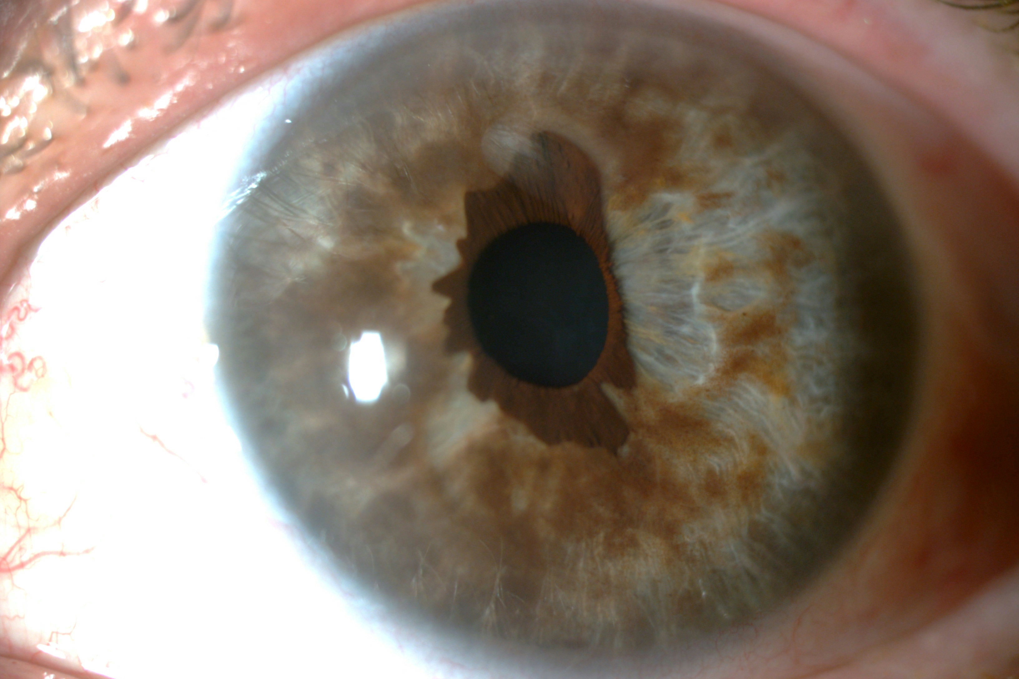 Iris melanoma: a review - eyeonoptics