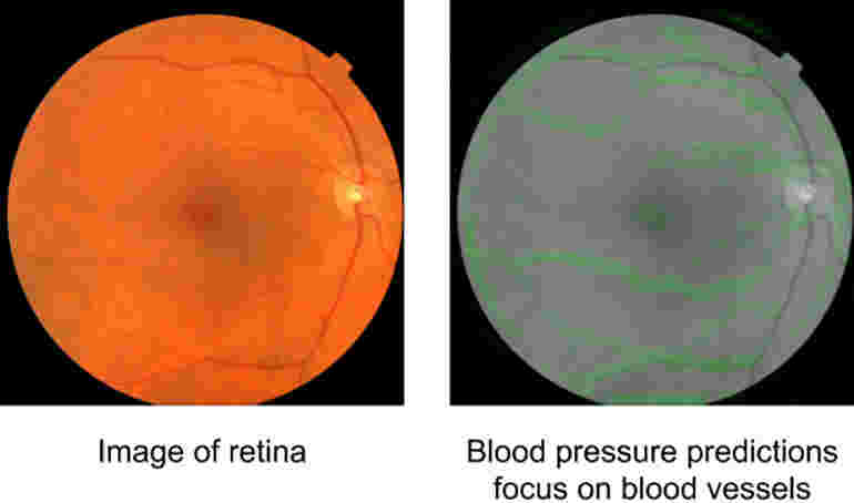 Retina scans and AI detect heart disease - eyeonoptics