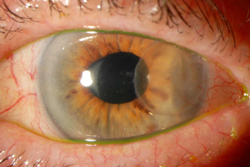 A rare case of Mycobacterium chelonae keratitis - nzoptics