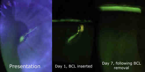 Bandage Contact Lenses - eyeonoptics