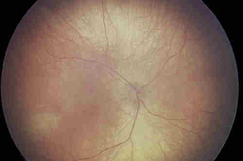 Screening of infants for ocular abnormalities - nzoptics