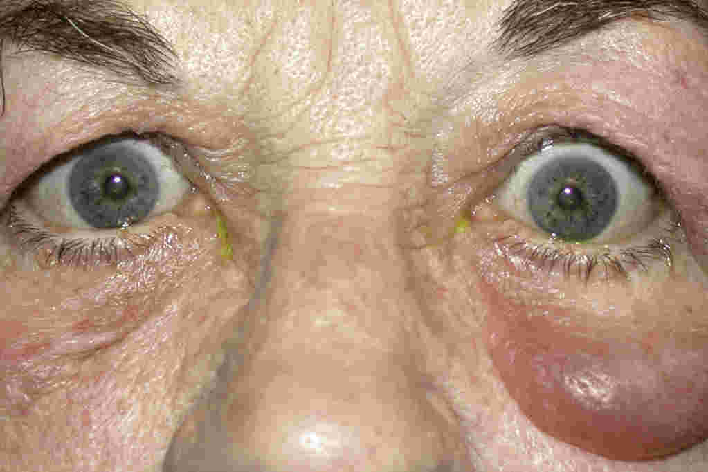 Thyroid-associated ophthalmopathy - eyeonoptics