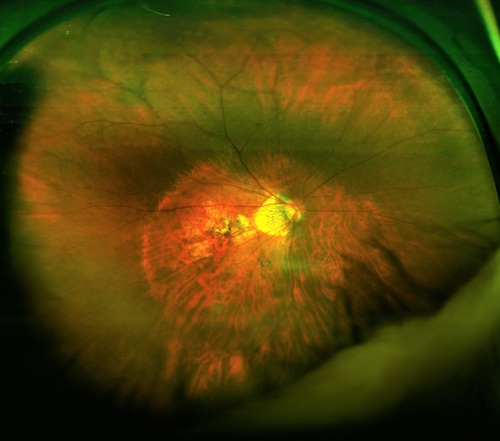 Tilted Optic Disc