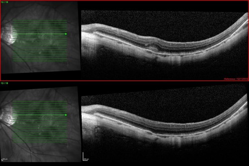 Pathologic myopic and myopic choroidal neovascularisation - nzoptics