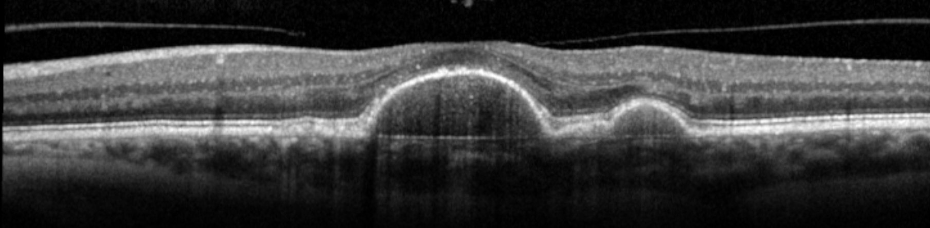CASE STUDY: Optimising outcome in non-exudative AMD