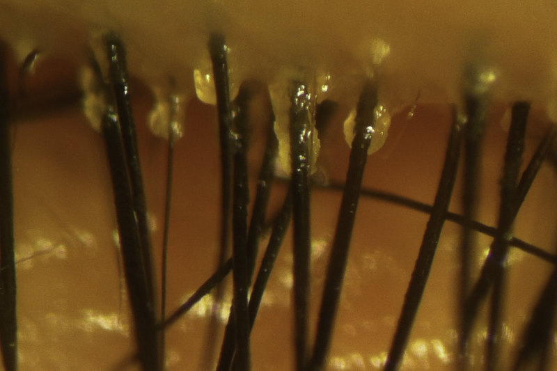 Antiparasitic efficacy of eyelid cleansers for Demodex blepharitis ...
