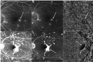 Uveitis research update - eyeonoptics