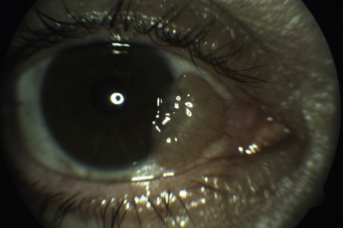 Summer’s blight: pterygia - nzoptics