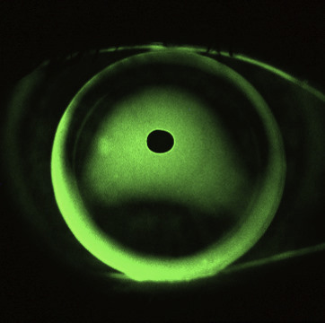 RGPs and corneal graft patients - nzoptics