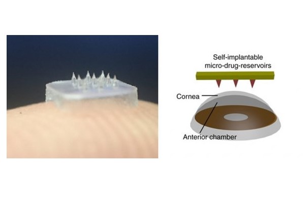 Corneal patch injects drugs - eyeonoptics