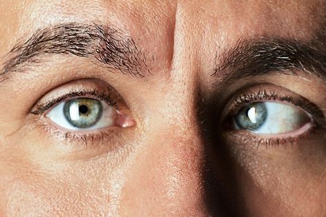 Calling strabismus patients! - nzoptics