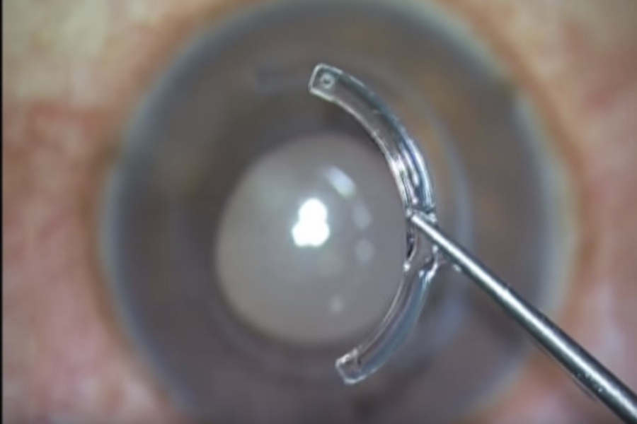 CAIRS better than ICRS? - eyeonoptics