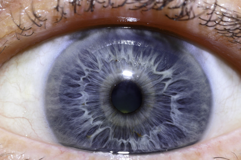 Corneal lenticule promising - eyeonoptics