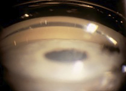 Gonioscopy – a closer look at the angle - nzoptics