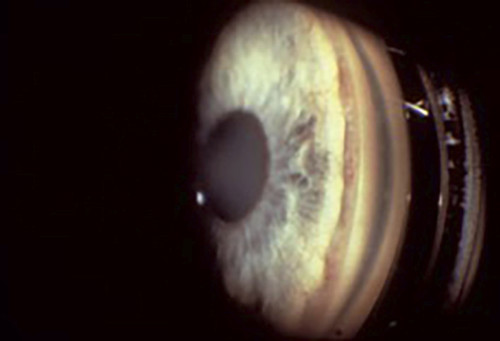 Iris Processes Gonioscopy Angle