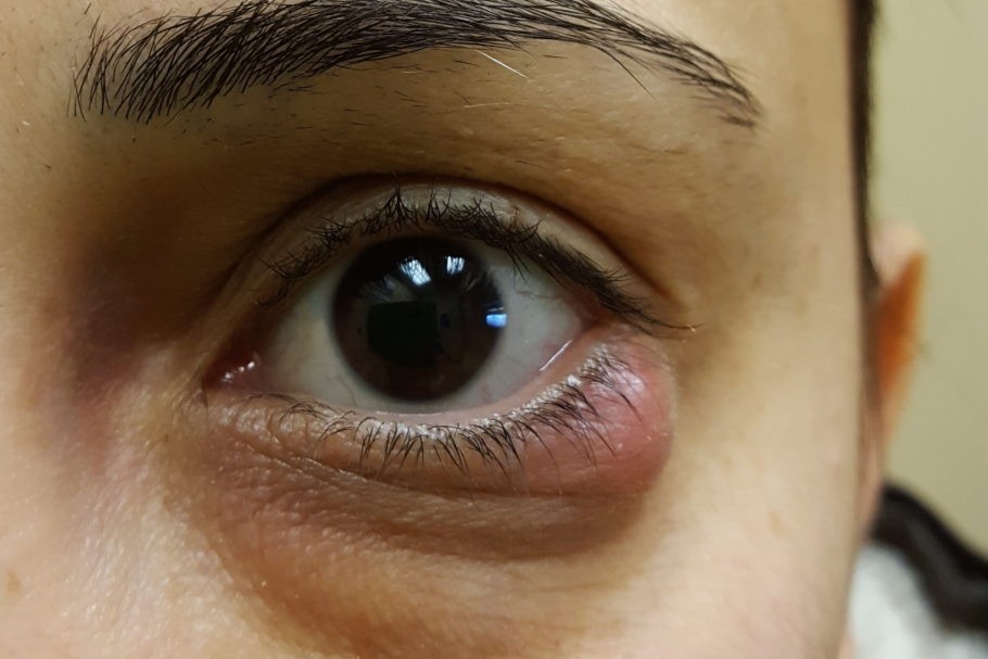 LLLT for chalazia? - eyeonoptics