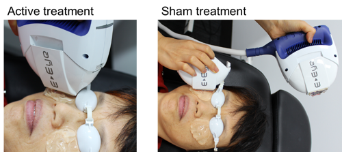 IPL therapy for MGD - nzoptics