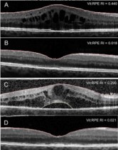 Uveitis research update