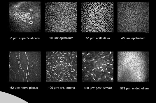 The return of the HRT3 corneal microscope - eyeonoptics