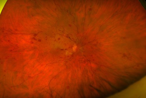 Neovascular glaucoma - nzoptics