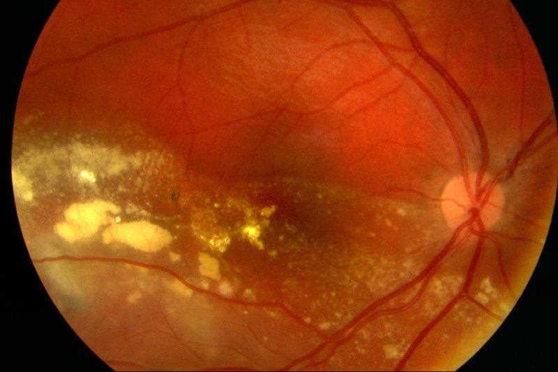 Primary retinal telangiectasia - eyeonoptics