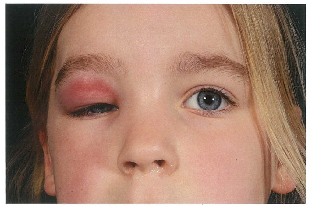 CASE STUDY: periorbital cellulitis or worse? - nzoptics