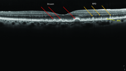 Getting to grips with RPD and AMD - nzoptics