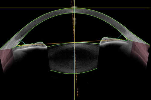 Anterion adds ectasia, keratoconus power