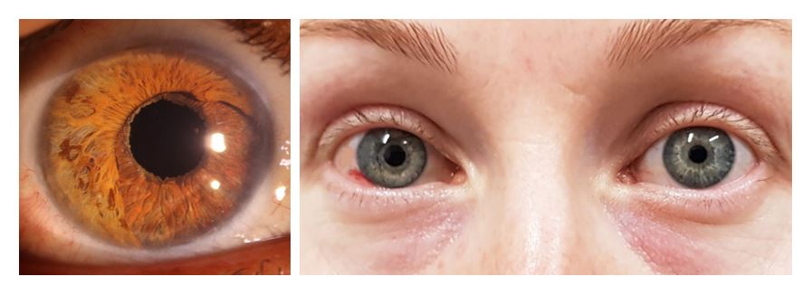 Contemporary surgical managment of iris tumours and reconstruction