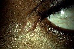 Sarcoidosis and the eye - eyeonoptics