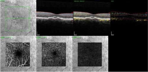 CASE STUDY: non-neovascular subretinal fluid in AMD - nzoptics