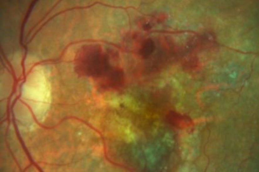 Six-monthly wet AMD IVT - eyeonoptics