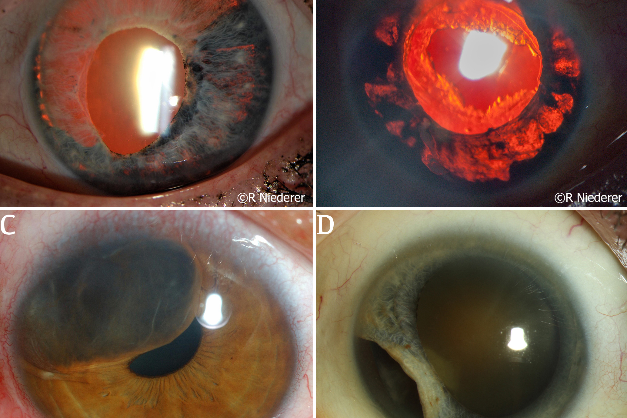 The iris in health and disease, part II: Iris transillumination defects ...