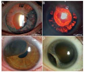 The iris in health and disease, part II: Iris transillumination defects ...