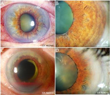 The iris in health and disease, part II: Iris transillumination defects ...