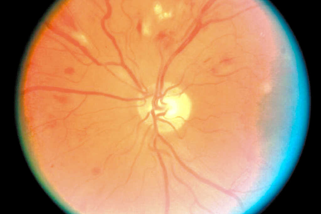 Hope for first DMI treatment - nzoptics