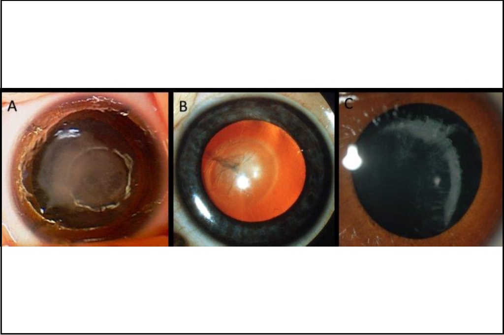 Genetic Advances And Impact On Paediatric Eyecare Focus On Congenital
