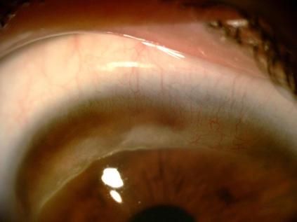 Terriens Marginal Degeneration