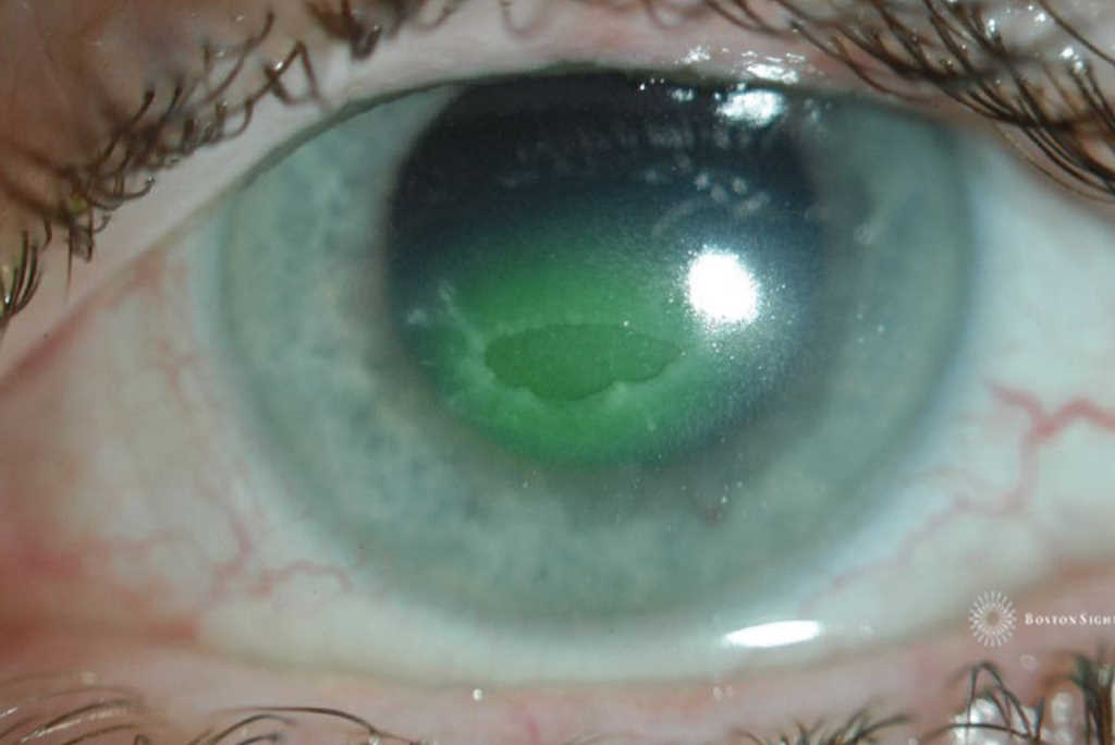 PCED drop trial starts - nzoptics