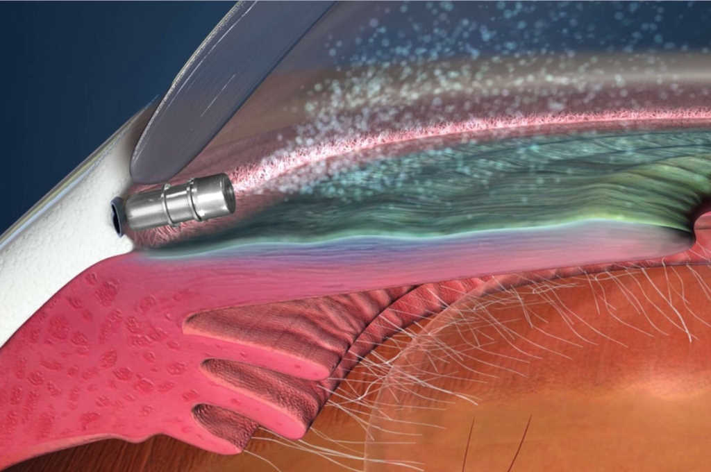 Glaukos’ milestones announced - nzoptics