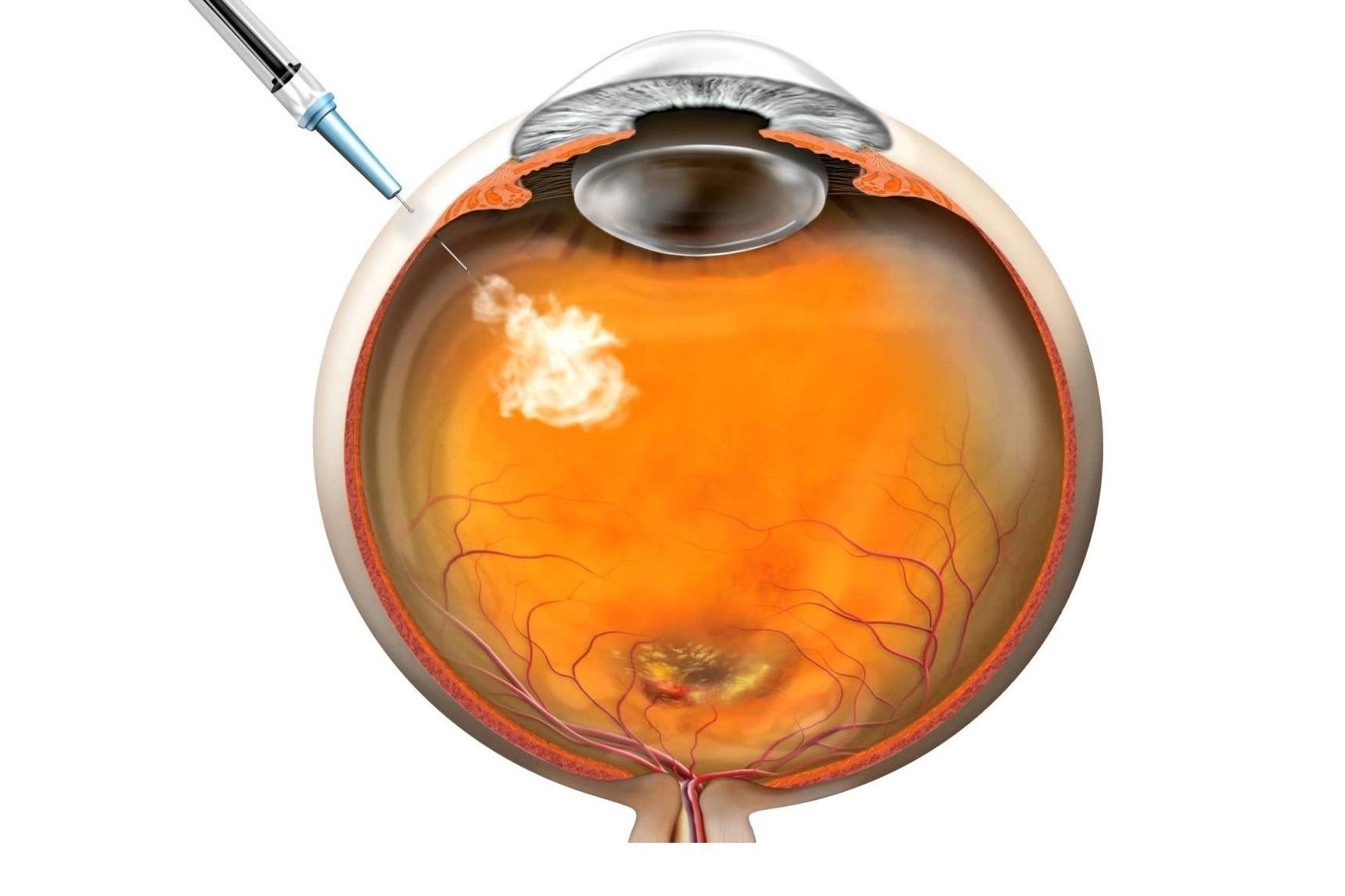 DIY slit lamp shield - nzoptics