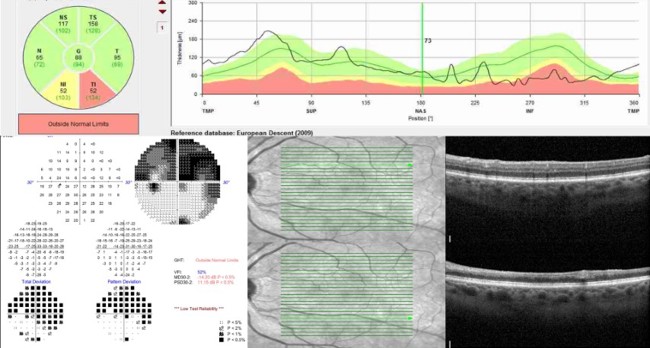 Ischaemic optic neuropathy or retinal artery occlusion? - nzoptics