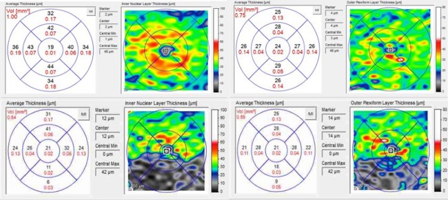 Ischaemic optic neuropathy or retinal artery occlusion? - nzoptics