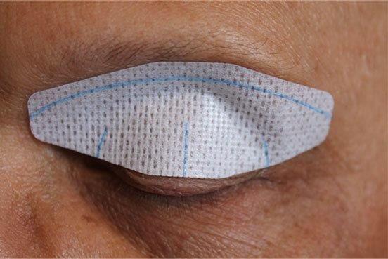 Better solution for eyelid closure - nzoptics