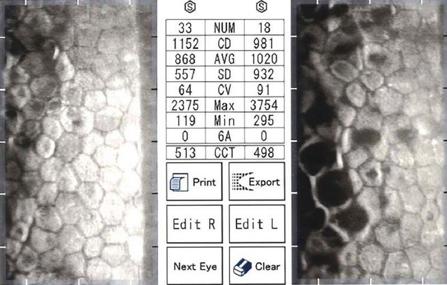 Fuchs’ endothelial corneal dystrophy: beaten metal to rock - nzoptics
