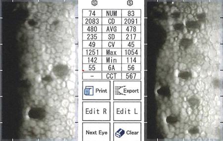 Fuchs’ endothelial corneal dystrophy: beaten metal to rock - nzoptics
