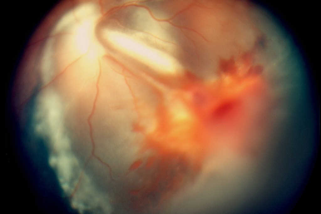 Posterior-eye treatment potential - nzoptics