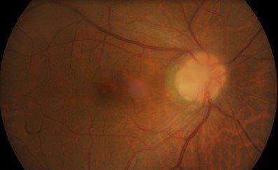 Optic disc pit with maculopathy - nzoptics