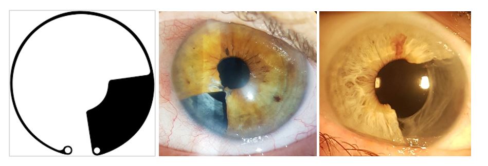 Contemporary surgical managment of iris tumours and reconstruction