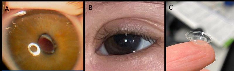Genetic advances and impact on paediatric eyecare: focus on congenital ...